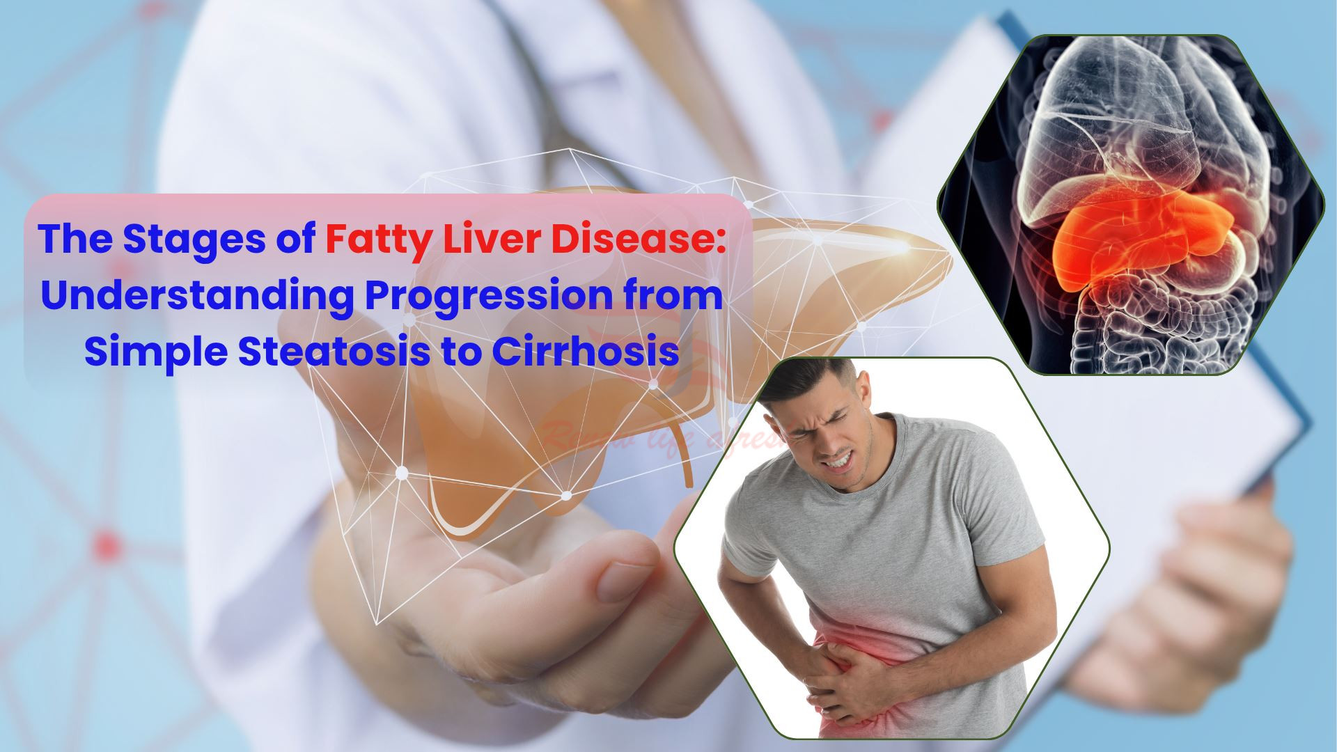The Stages of Fatty Liver Disease: Steatosis to Cirrhosis